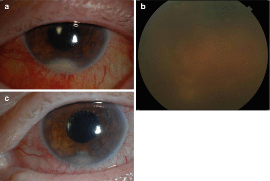 Endophthalmitis: An Overview | SpringerLink