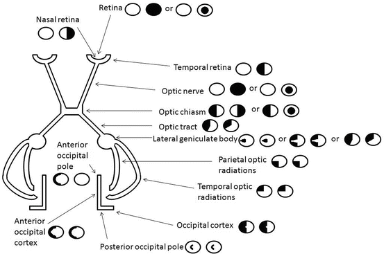 Visual Loss and Other Visual Disturbances | SpringerLink