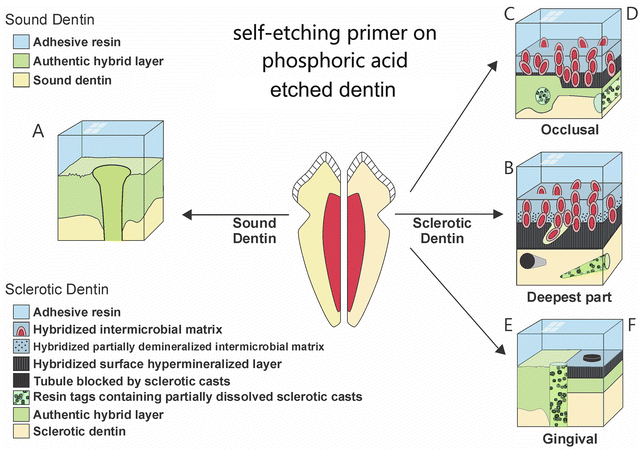 Cervical Sclerotic Dentin: Resin Bonding | SpringerLink