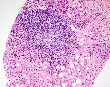 Portal Inflammation | SpringerLink