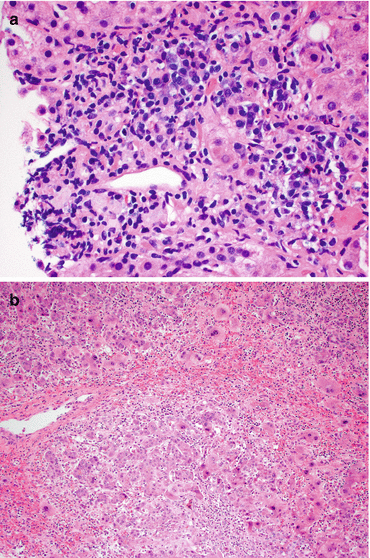 Portal Inflammation | SpringerLink