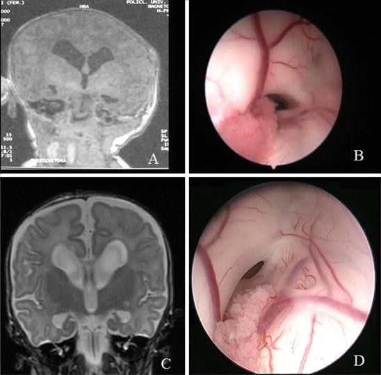 Endoscopic Third Ventriculostomy Technique Springerlink