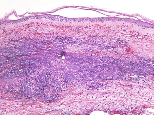 Meningococcemia and Purpura Fulminans | SpringerLink