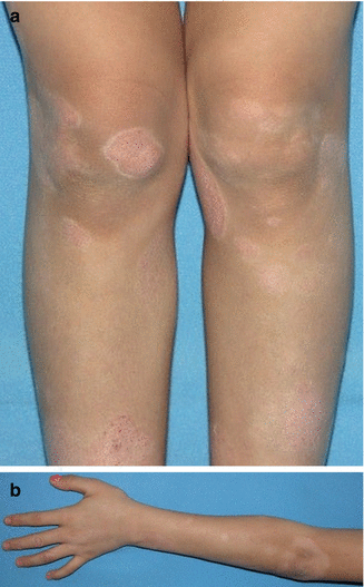 Childhood Pityriasis Rubra Pilaris | SpringerLink