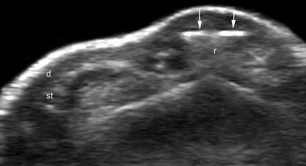 Ultrasound of the Subcutaneous Tissue | SpringerLink