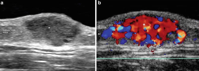 Ultrasound of the Subcutaneous Tissue | SpringerLink