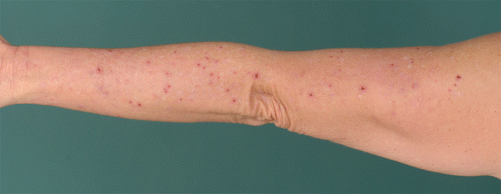 Brachioradial Pruritus | SpringerLink