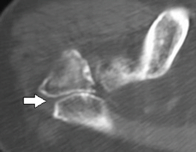 Subacromial Space and Rotator Cuff Anatomy | SpringerLink