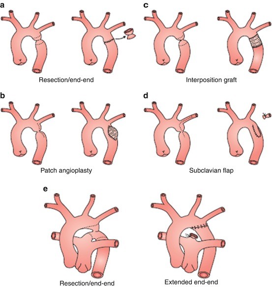 Coarctation of the Aorta | SpringerLink