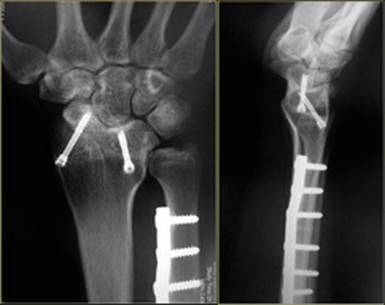 Arthroscopic Reconstructive Procedures for Kienböck’s Disease ...