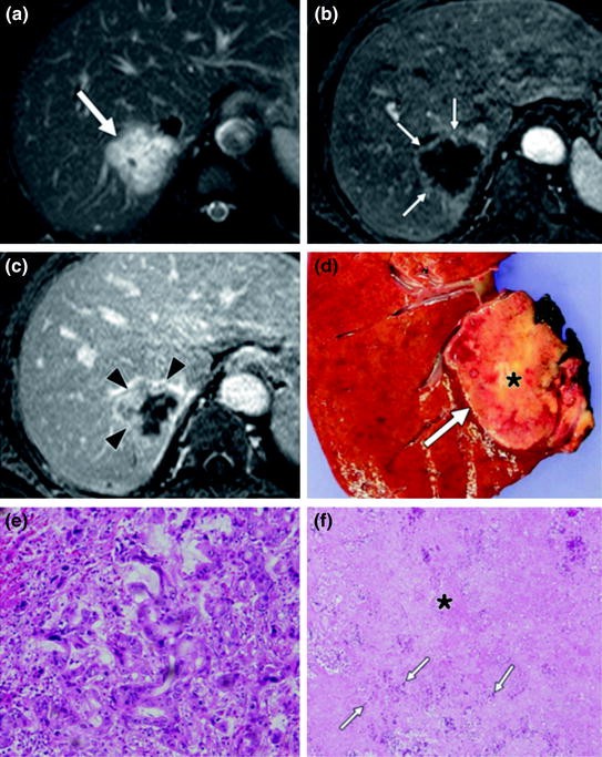 Diagnosis and Management of Intrahepatic and Extrahepatic Cholangiocarcinoma | SpringerLink
