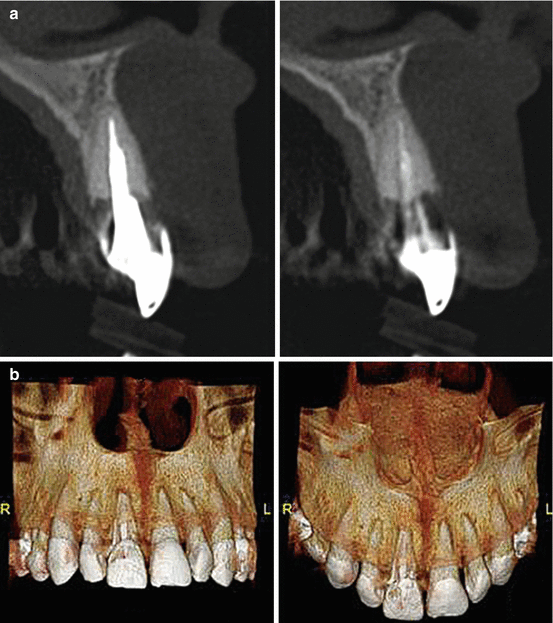 Intracoronal Whitening of Endodontically Treated Teeth | SpringerLink