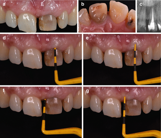 Intracoronal Whitening of Endodontically Treated Teeth | SpringerLink