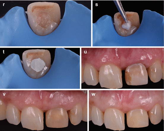 Intracoronal Whitening of Endodontically Treated Teeth | SpringerLink