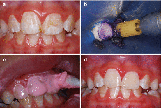 Enamel Microabrasion for Removal of Superficial Coloration and Surface ...