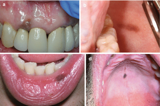 Common Lesions in Oral Pathology for the General Dentist | SpringerLink