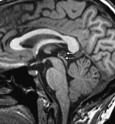Pineal Gland: Normal Size, Appearance, and Enhancement | SpringerLink