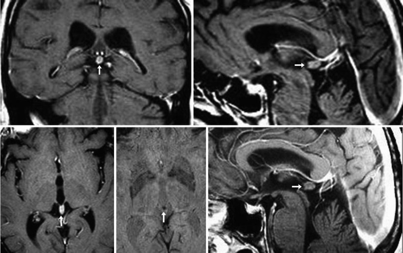 Pineal Gland: Normal Size, Appearance, and Enhancement | SpringerLink