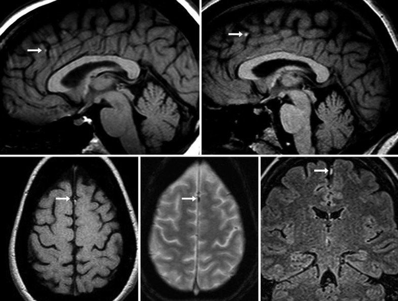 Dural Calcifications: Normal Locations and Appearances | SpringerLink