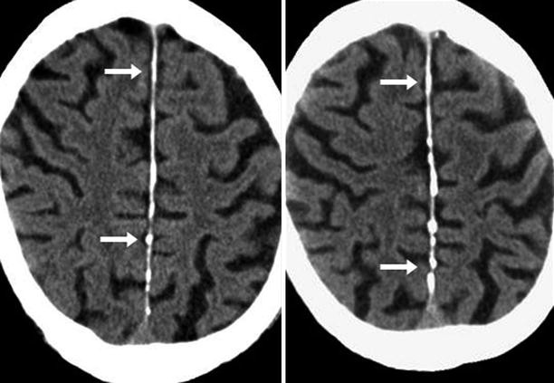 Dural Calcifications: Normal Locations and Appearances | SpringerLink