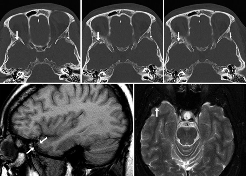 Dural Calcifications: Normal Locations and Appearances | SpringerLink