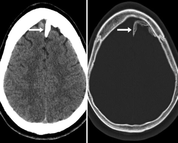 Dural Calcifications: Normal Locations and Appearances | SpringerLink