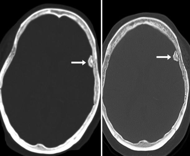 Dural Calcifications: Normal Locations and Appearances | SpringerLink