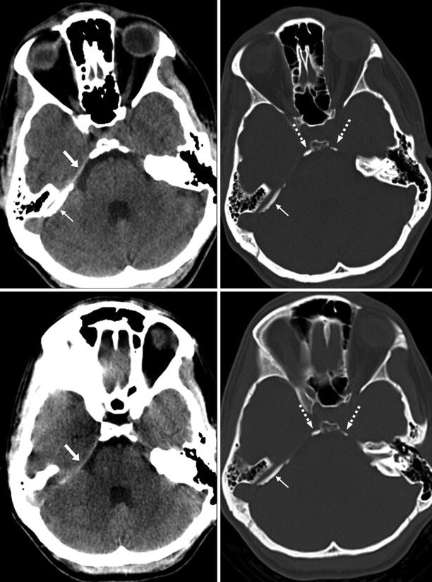 Dural Calcifications: Normal Locations and Appearances | SpringerLink