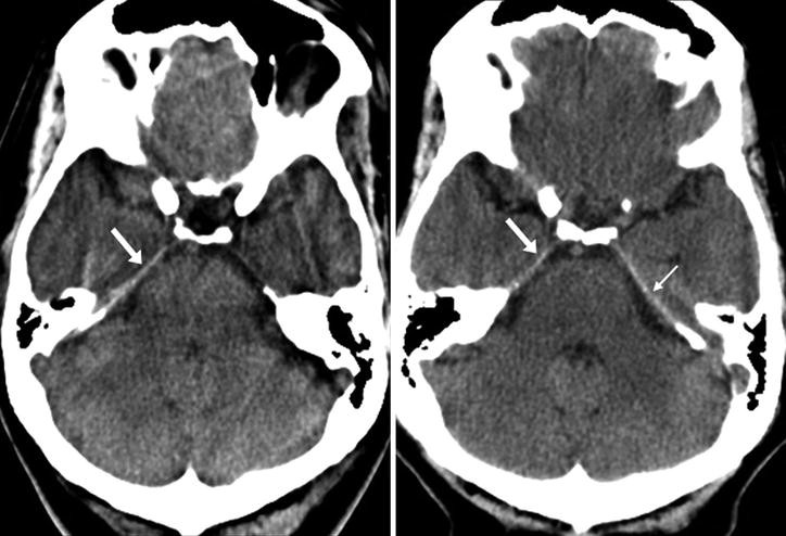 Dural Calcifications: Normal Locations and Appearances | SpringerLink