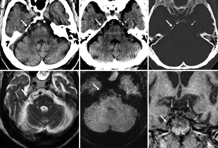 Dural Calcifications: Normal Locations and Appearances | SpringerLink