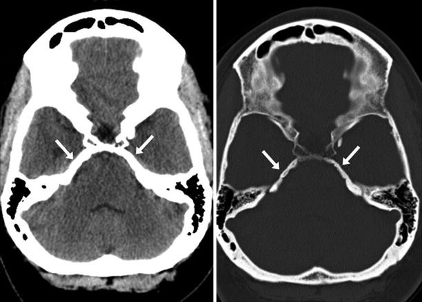 Dural Calcifications: Normal Locations and Appearances | SpringerLink