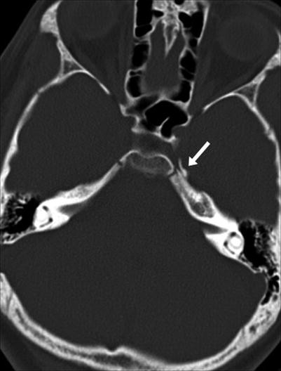 Dural Calcifications: Normal Locations and Appearances | SpringerLink