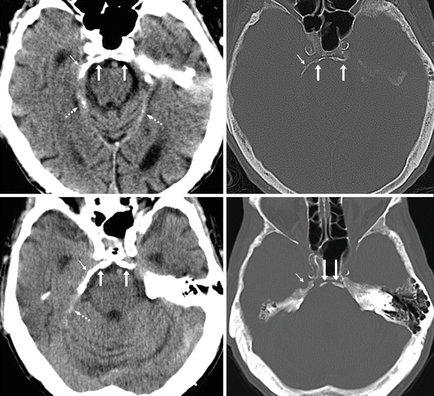 Dural Calcifications: Normal Locations and Appearances | SpringerLink