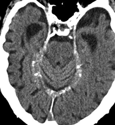 Dural Calcifications: Normal Locations and Appearances | SpringerLink