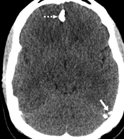 Dural Calcifications: Normal Locations and Appearances | SpringerLink