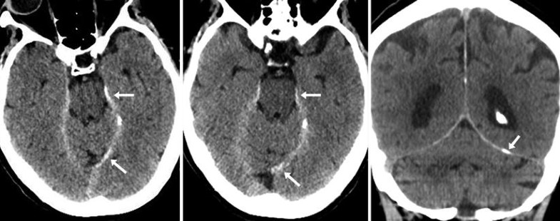 Dural Calcifications: Normal Locations and Appearances | SpringerLink