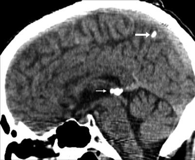Dural Calcifications: Normal Locations and Appearances | SpringerLink
