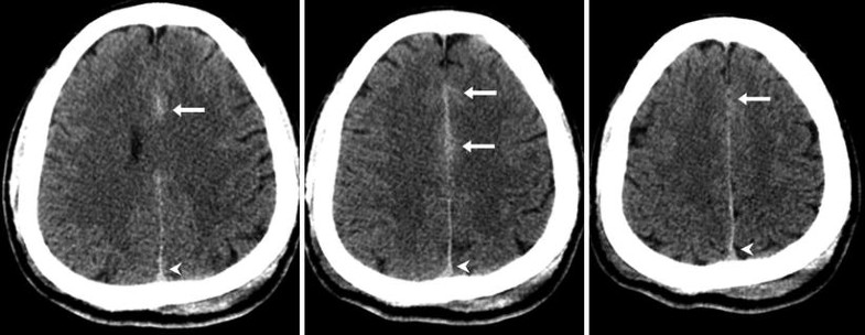 Dural Calcifications: Normal Locations and Appearances | SpringerLink