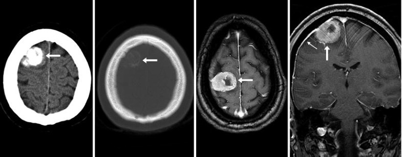 Dural Calcifications: Normal Locations and Appearances | SpringerLink