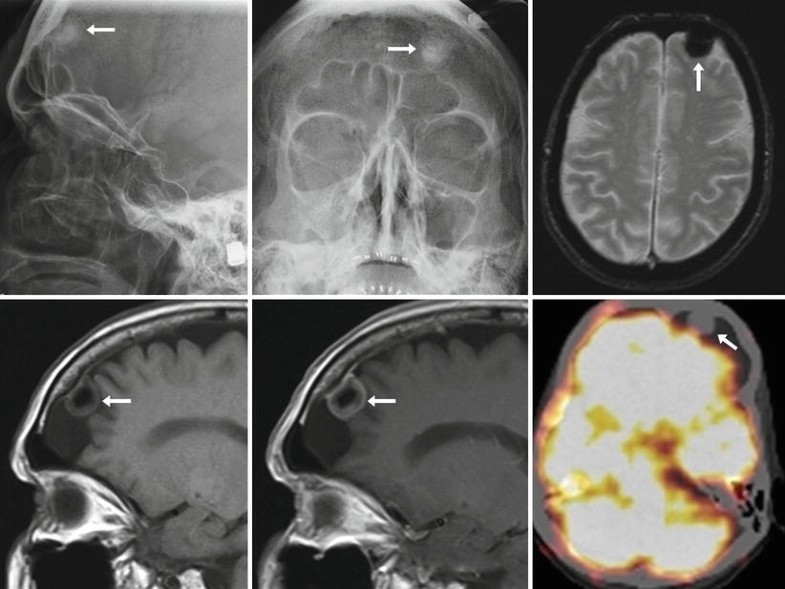 Dural Calcifications: Normal Locations and Appearances | SpringerLink