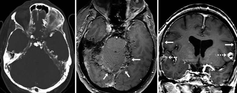 Dural Calcifications: Normal Locations and Appearances | SpringerLink