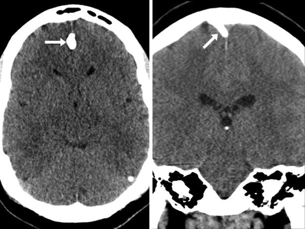 Dural Calcifications: Normal Locations and Appearances | SpringerLink