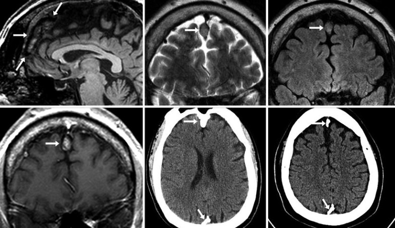 Dural Calcifications: Normal Locations and Appearances | SpringerLink