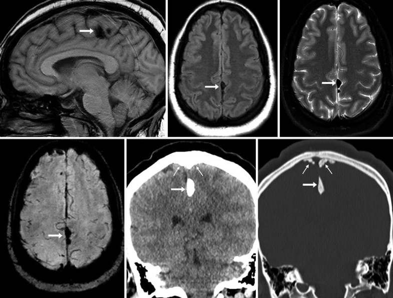 Dural Calcifications: Normal Locations and Appearances | SpringerLink