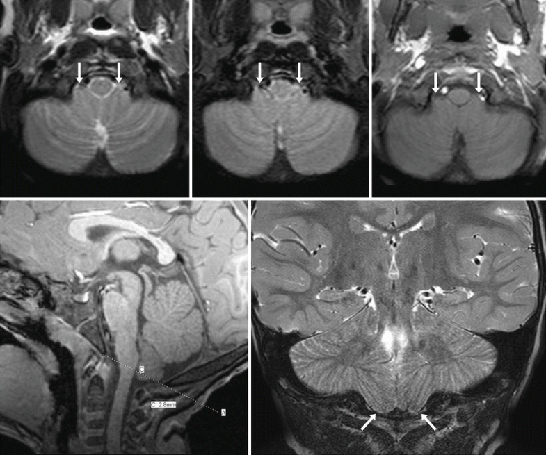Cerebellar Tonsillar Ectopia | SpringerLink