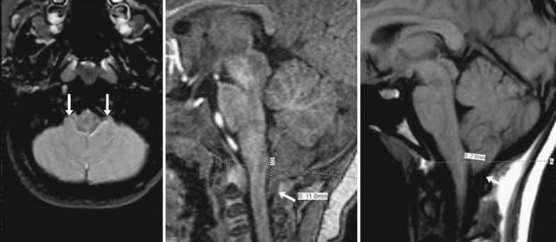 Cerebellar Tonsillar Ectopia | SpringerLink
