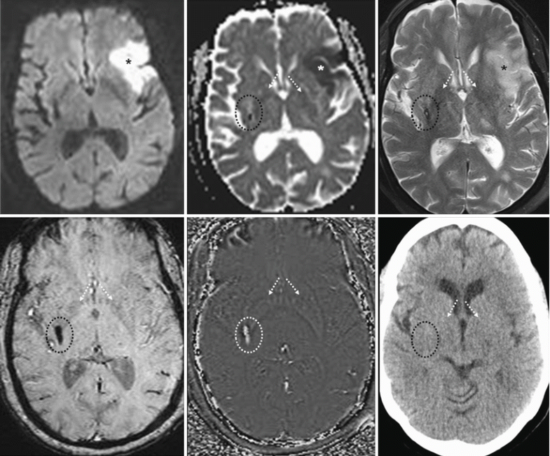 Susceptibility-Weighted Imaging: Concepts, Basal Ganglia Variation in ...