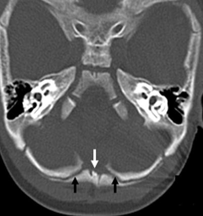 Pediatric Skull: Normal Pediatric Sutures on Computed Tomography ...