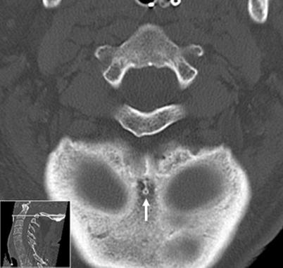 Pediatric Skull: Normal Pediatric Sutures on Computed Tomography ...