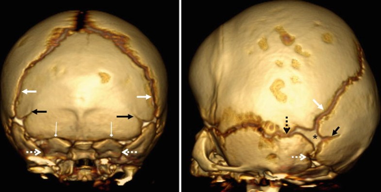 Pediatric Skull: Normal Pediatric Sutures on Computed Tomography ...